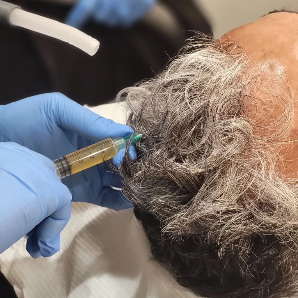 PRP Hair Restoration - AW Medspa